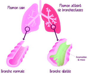 Dilatation des bronches - DDB ou Bronchectasie - RespiFIL - Filière de ...